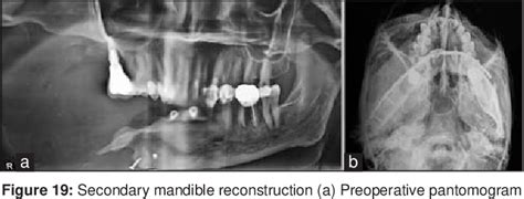 Figure 19 From A Novel 3d Template For Mandible And Maxilla Reconstruction Rapid Prototyping