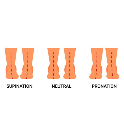 What You Need To Know About Supination Causes And Treat Payatek