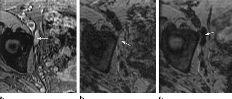 Benign Pelvic Lymph Node In A Patient With Bladder Cancer A