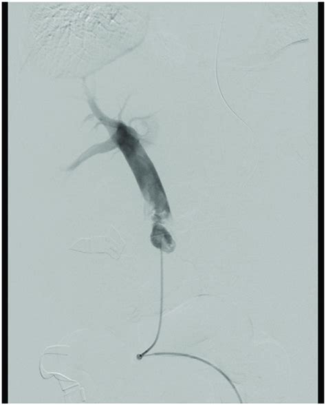 Post Thrombolysis Mesenteric Venogram Showing Reduction Of Clot Burden Download Scientific