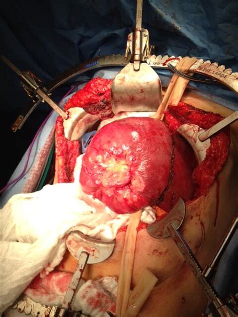 Large Liver Tumor For Resection Cancer Surgery Associates