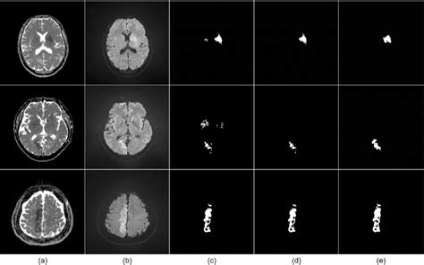 Examples Of The Results Of Infarct Core Segmentation On Dwi A Adc Map Download Scientific