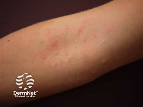Atopic Flexural Eczema Images