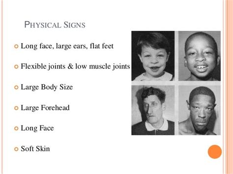 Long Face Syndrome Symptoms Fragile X Syndrome Futureslps