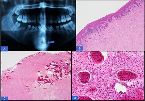 A Ct Scan Sagittal Plane Showing An Expansile Lesion Involving The