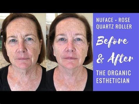 Pin On Nuface Before And After