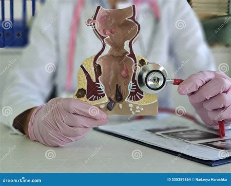 Doctor Holds Model Of Unhealthy Lower Rectum With Inflamed Vascular