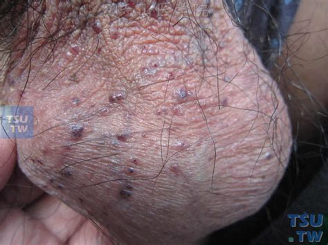 良性肿瘤：血管角皮瘤（angiokeratoma）症状表现 皮肤病学 天山医学院