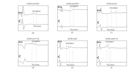 Delineation Of T Wave Examples Of T Waves From Qtdb Records With