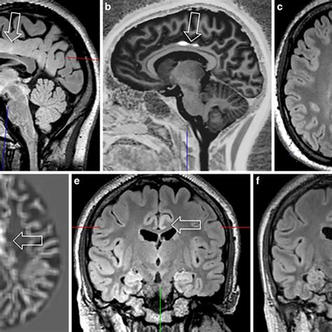 A 12 Year Old Girl Presented With Daily Sensory And Bilateral Tonic