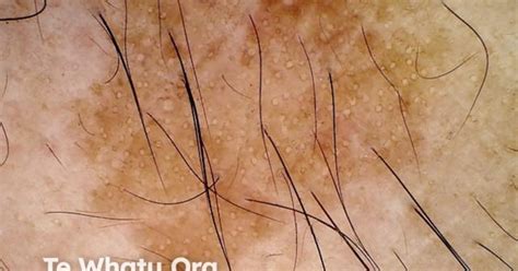 Solar Lentigo Dermoscopy Image