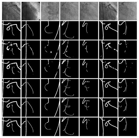 Synthesize And Segment Towards Improved Catheter Segmentation Via