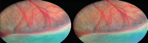 Smartphone Based Fundus Documentation In Retinopathy Of Prem