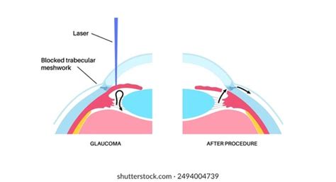 Surgical Iridectomy Procedure Intraocular Pressure Problem Stock Vector