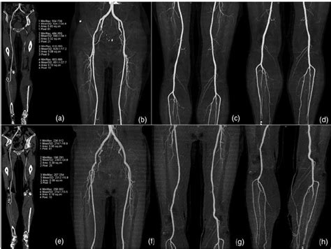 Lower Extremity Cta At 70 Kvp In A 60 Year Old Woman Ad And At 120
