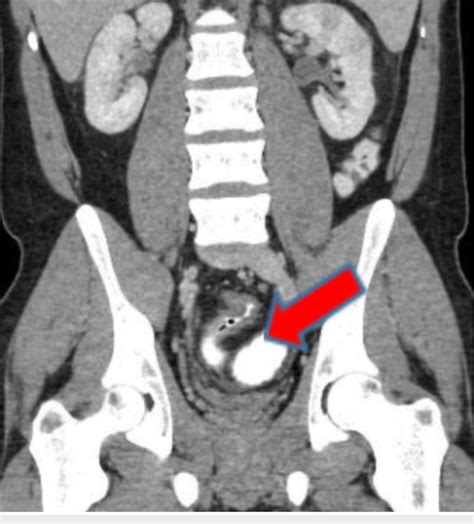 Ct Scan Showing Abnormal Wall Thickening Of Sigmoid Colon Indicated By Download Scientific