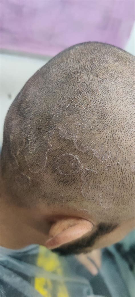 What Are This Circle Patches After I Shaved My Head Rdandruff
