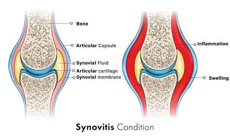 Ankle Impingement Problems Physioflow Pt Physical Therapy