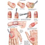 Cellulitis And Epidermal Abscess
