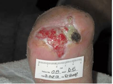 Amputation Stump With Necrotic Yellow Fibrinous And Granulation Tissue