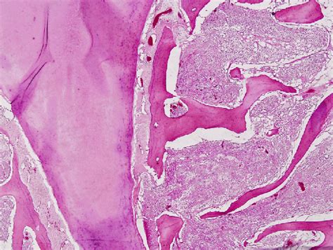 Osteoblastic Type Jaw Bone Osteosarcoma Invasion Into The Periodontal Download Scientific