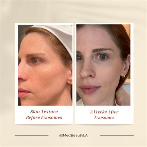 Microneedling With Exosomes In La Medbeautyla