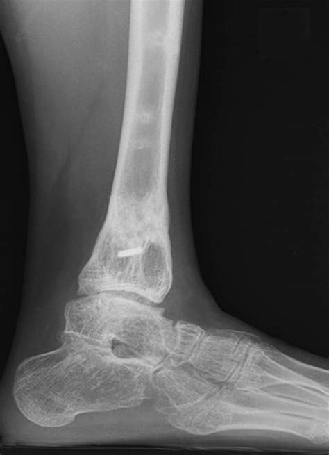 Treatment Of A Severe Neglected Valgus Deformity After Excision Of The