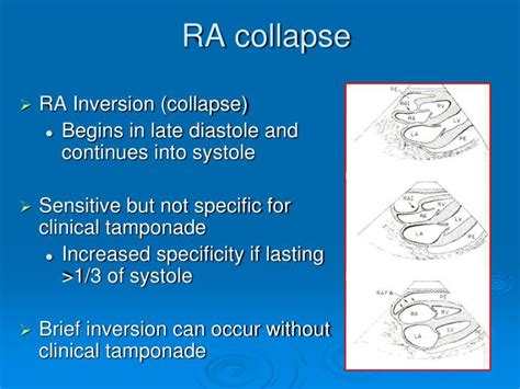 Ppt Cardiac Tamponade Powerpoint Presentation Id 5026067