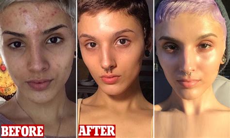 Tretinoin Before And After
