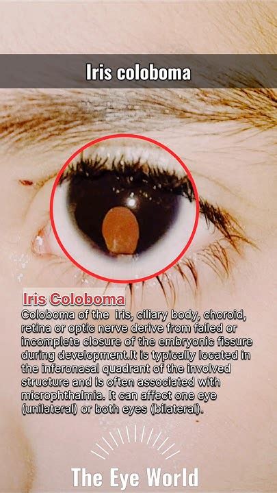 Iris Coloboma Eyes Ophthalmology Iris Youtube