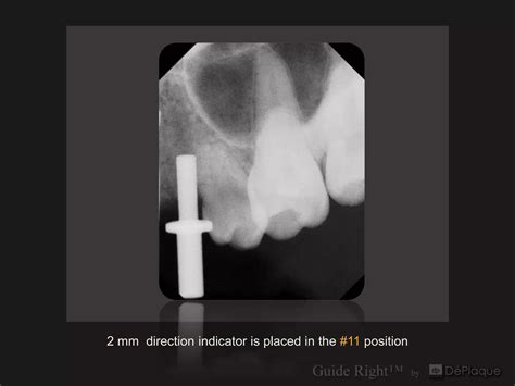 10 3 Mm Implants In Narrow Space Angular And Linear Corrections Ppt