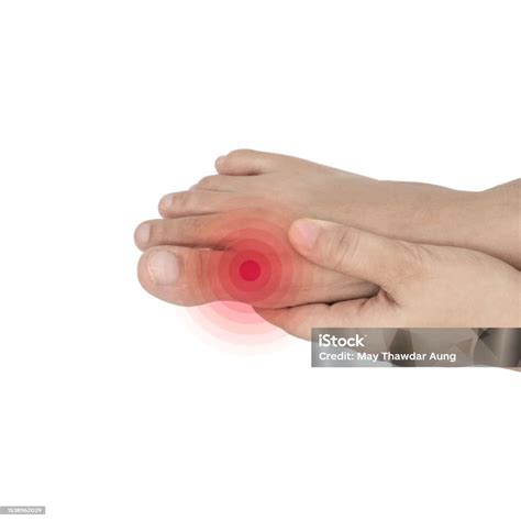 Peradangan Di Pangkal Jempol Kaki Konsep Nyeri Sendi Kaki Tersandung Radang Sendi Hyperuricema