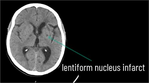 Hypodense And Hyperdense In Ct Ct Scan And Mri