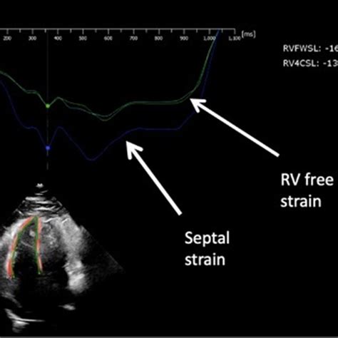 Right Ventricular Strain Computed For The Free Wall And The Global