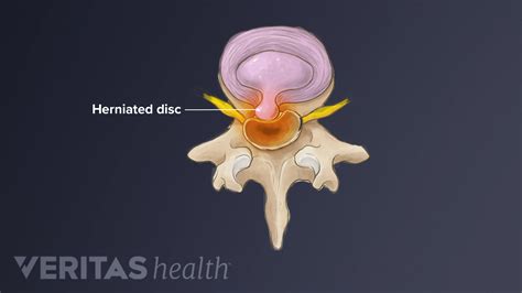 Diagnosing A Lumbar Herniated Disc
