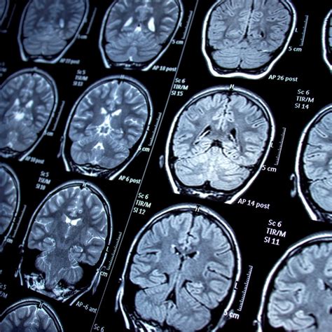 Alzheimers Classification Dataset Kaggle