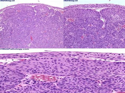 Cap Protocol Bladder Pptx