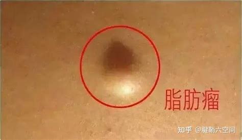别怕，这6种 瘤”恶化的几率微乎其微 知乎