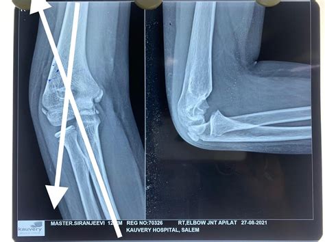 Gun Stock Deformity Seen In At Anthony Sears Blog