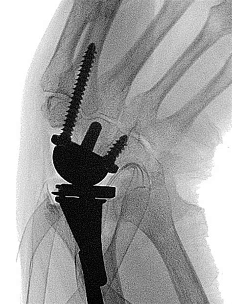 Patients Kinematx Total Wrist Arthroplasty