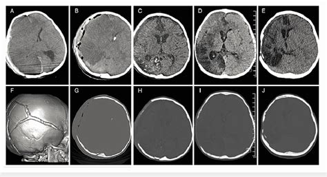 Non Contrast Head Cts At Successive Time Intervals Pre And Post Middle