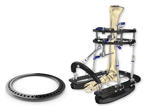 Hoffmann Lrf Circular External Fixation Stryker
