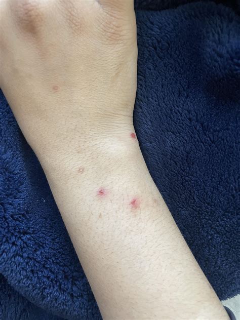Bug Bite Scabsscars Rbugbites