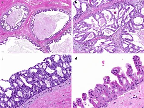 Pure Apocrine Intraductal Carcinoma Of Salivary Glands Reassessment Of