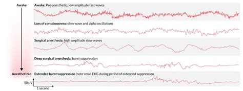 Tiva Anesthesia Vs General Anesthesia Lets Discuss