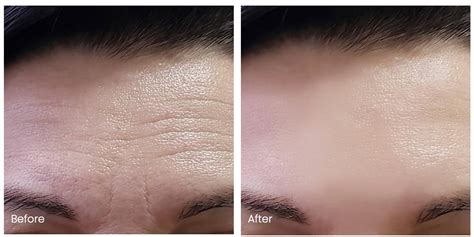 Preventative Botox Guide Stop Wrinkles Early