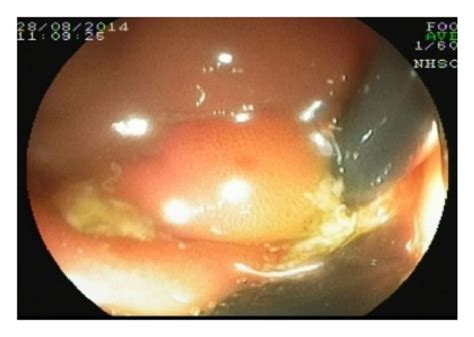 A Echoendoscope Was Advanced Into The Duodenal Bulb After Checking Download Scientific