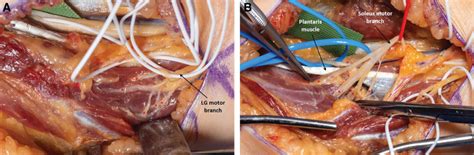 Combined Surgical Technique Of Hyperselective And Partial Motor Neurectomies For Spastic Equinus