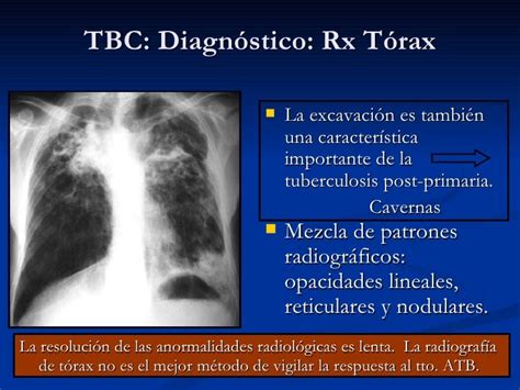 Tuberculosis Clase[1]