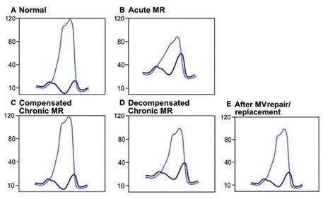 A Brief Review Of Hemodynamics For Structural Interventions Part 1